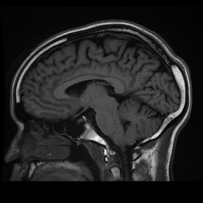 Ultra-High Fields (UHF) Human MRI: Living Brain imaged with 11.7 Tesla ...